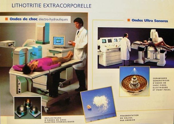 lithotritie extracorporelle douleur